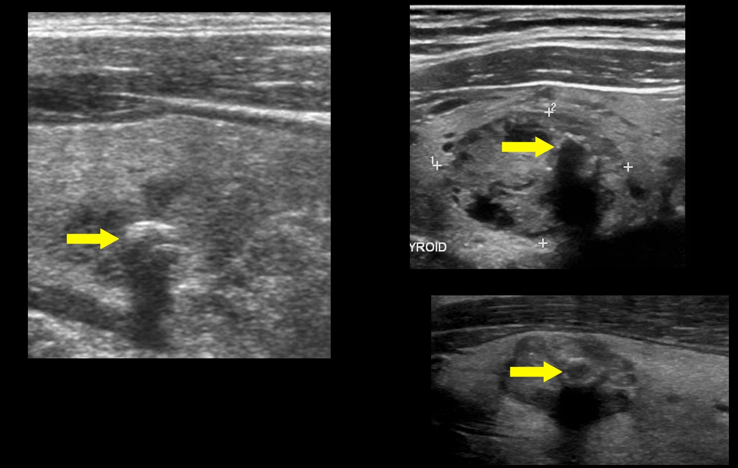 TIRADS Calculator - Thyroid Nodule Risk Assessment Tool
