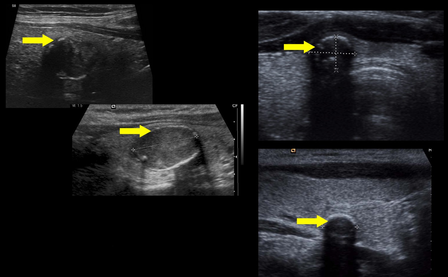 TIRADS Calculator - Thyroid Nodule Risk Assessment Tool