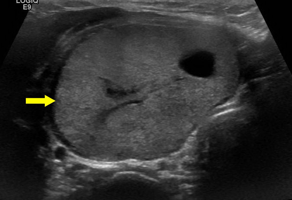 TIRADS Calculator - Thyroid Nodule Risk Assessment Tool