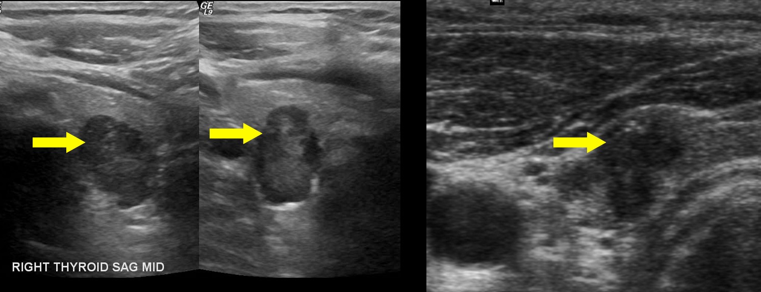 TIRADS Calculator - Thyroid Nodule Risk Assessment Tool